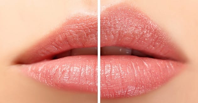 Permanent lip augmentation - Bullhorn lip lift - Atlas estetic
