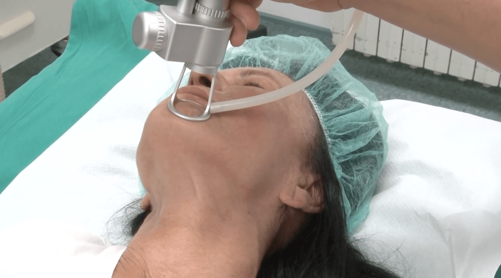 Laserski piling lica - Dr Lazar Pajević